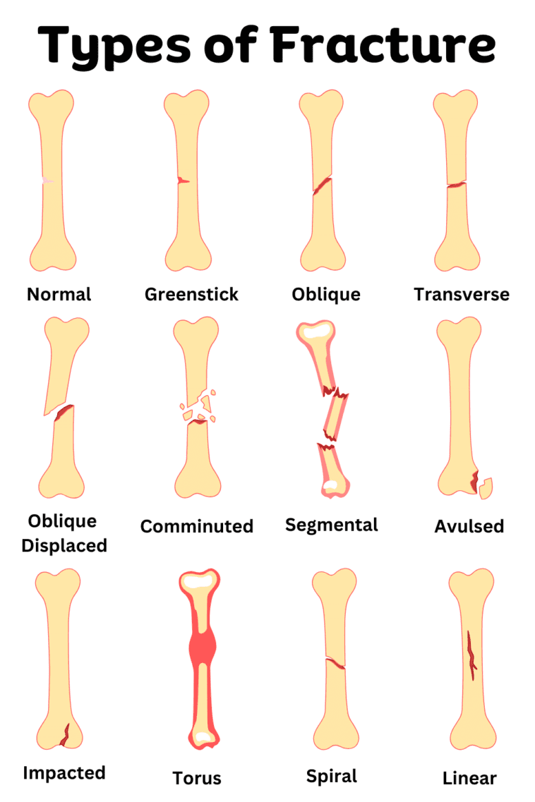 Names and Types of Bone Fractures Made Easy